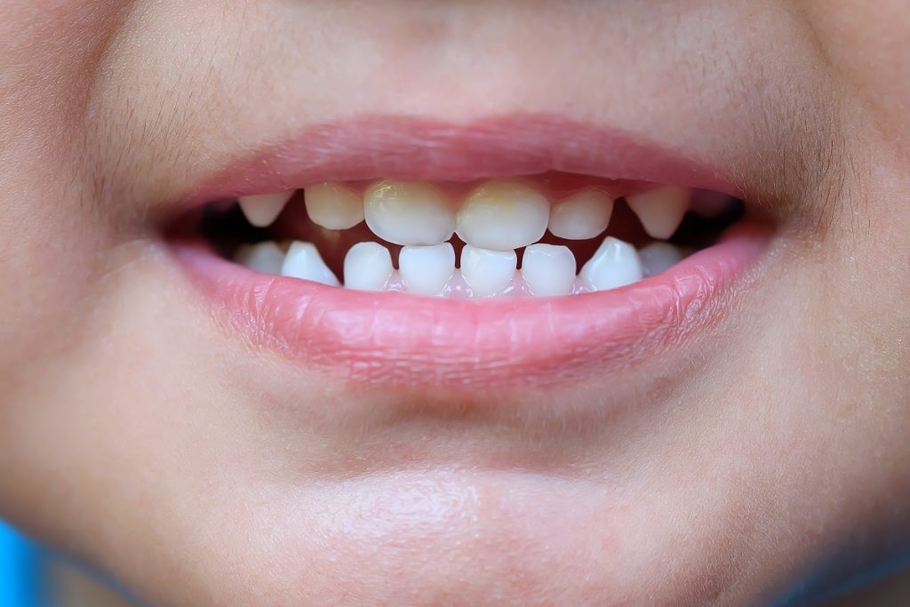 Treatments Used For Enamel Hypoplasia Of Milk Teeth Catsup And Mustard Treatments Used For Enamel Hypoplasia Of Milk Teeth Catsup And Mustard